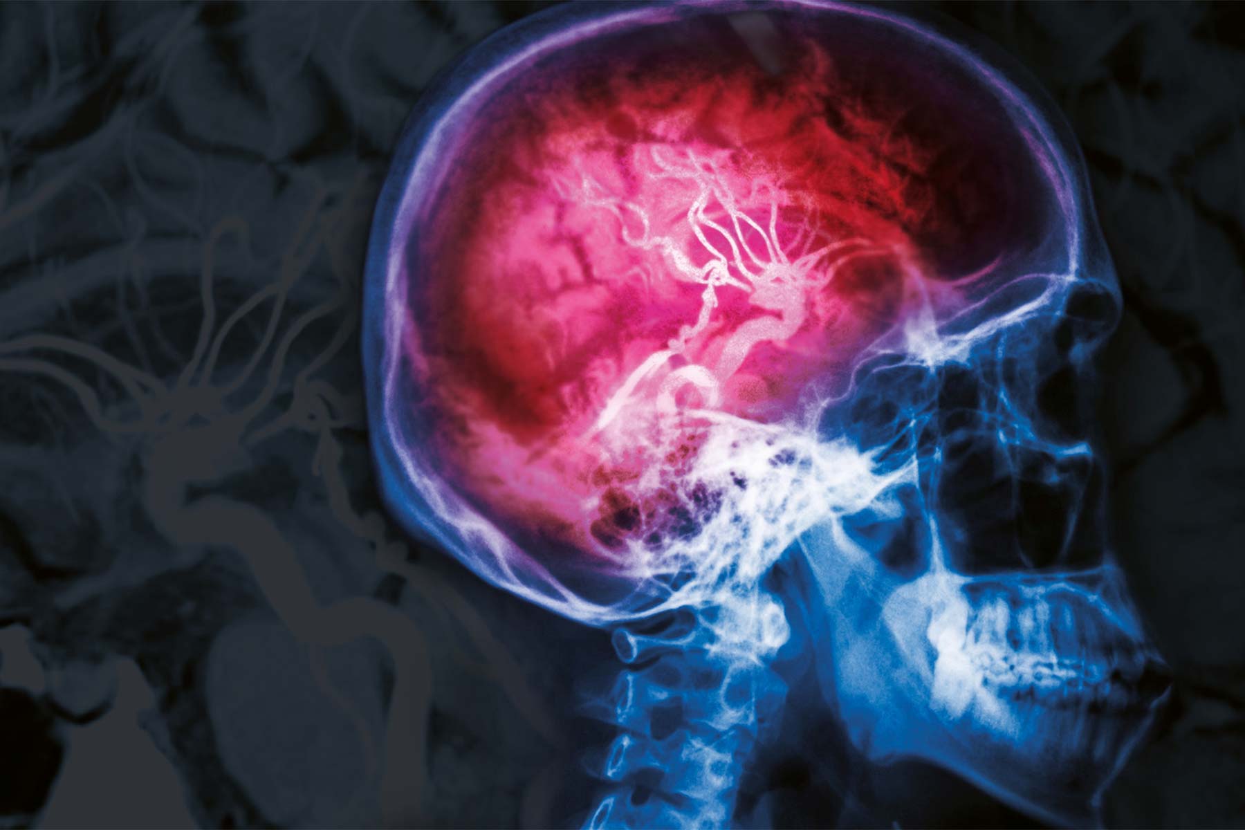 Cerebrovascular Diseases | Karger Publishers