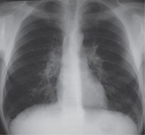 Enfermedad pulmonar intersticial en un usuario de drogas intravenosas ...
