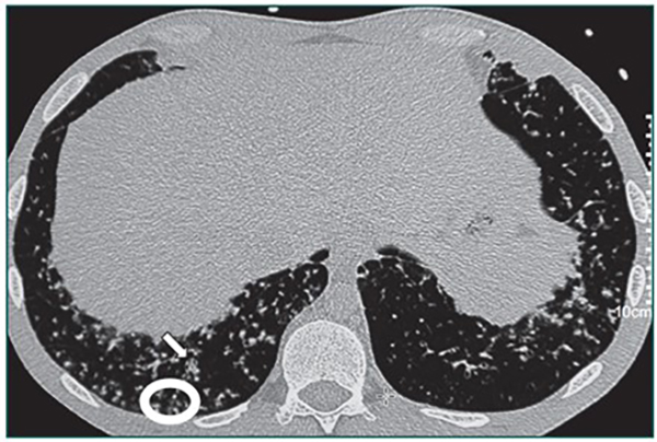 Enfermedad pulmonar intersticial en un usuario de drogas intravenosas ...