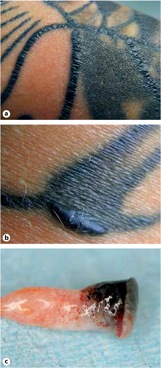 Tattoo Complaints and Complications: Diagnosis and Clinical Spectrum ...