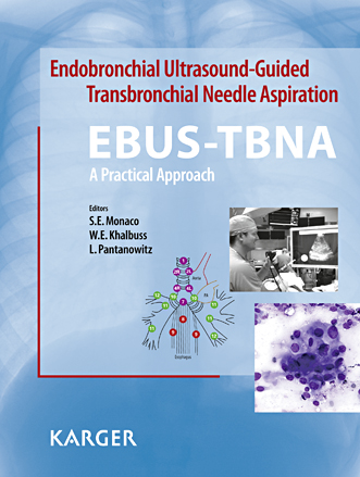 EBUS-TBNA Specimen Collection and Processing | Endobronchial Ultrasound-Guided Transbronchial ...