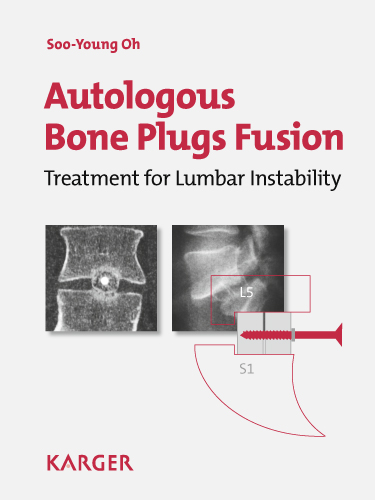 Steps Towards Recognition | Autologous Bone Plugs FusionTreatment for ...