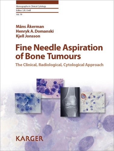 Cytological Features of Bone Tumours in FNA Smears IV: Notochordal ...