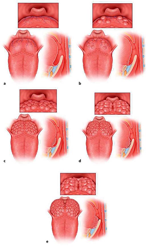 Updated Friedman Staging System for Obstructive Sleep Apnea | Sleep ...