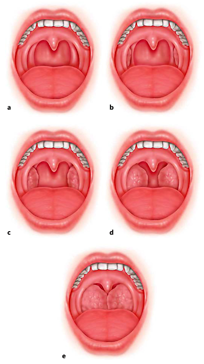 Updated Friedman Staging System for Obstructive Sleep Apnea | Sleep ...
