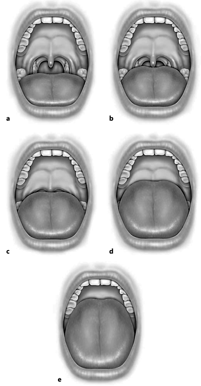 Updated Friedman Staging System for Obstructive Sleep Apnea | Sleep ...