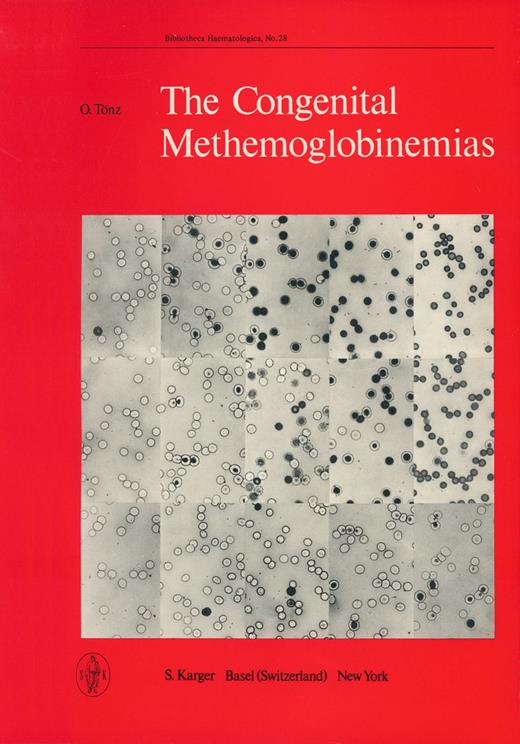 VII. Hemoglobin-M-Disease | The Congenital MethemoglobinemiasPhysiology ...