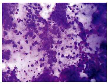 The Role of Intraoperative Cytology in the Diagnostic Evaluation of ...