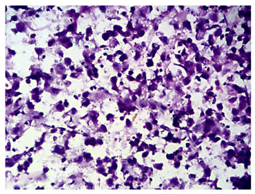 The Role of Intraoperative Cytology in the Diagnostic Evaluation of ...