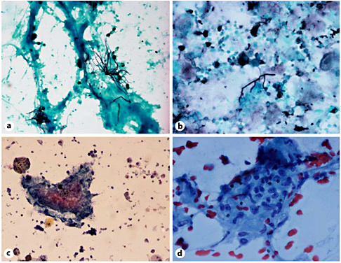 Pulmonary Mycoses Diagnosed Using Exfoliative Cytology: Infection or ...
