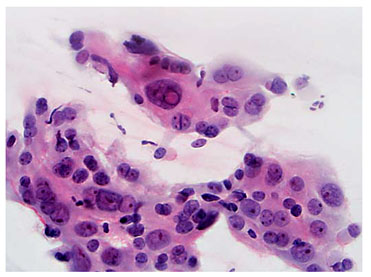 The Pap Test and Bethesda 2014 | Acta Cytologica | Karger Publishers