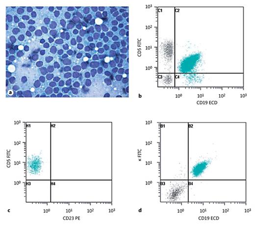 Lymph Node Fine-Needle Cytology of Non-Hodgkin Lymphoma: Diagnosis and ...