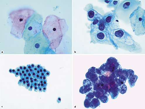Nuclear Morphology and the Biology of Cancer Cells | Acta Cytologica ...