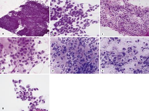 The Small Round Cell Sarcomas Complexities and Desmoplastic ...