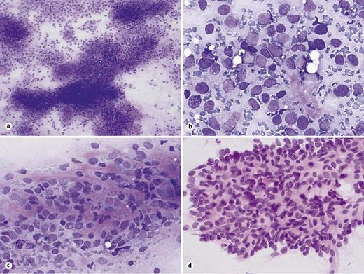The Small Round Cell Sarcomas Complexities and Desmoplastic ...
