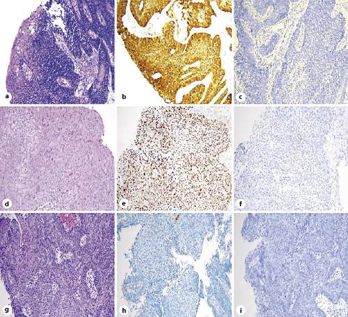 Aptima HR-HPV Testing of Cytology Specimens Is an Effective Supplement ...