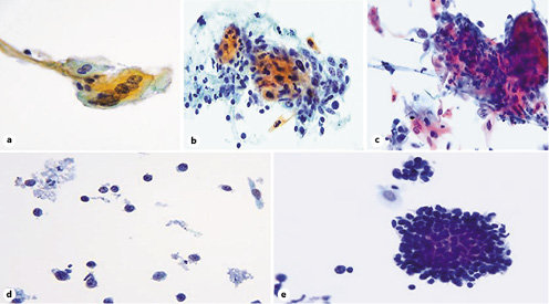 Aptima HR-HPV Testing of Cytology Specimens Is an Effective Supplement ...