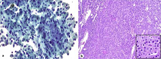 Oncocytic Tumors in the Thyroid: A Tri-Focal Review – Integrated ...