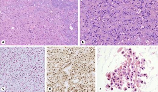 Oncocytic Tumors in the Salivary Gland: A Tri-Focal Review – Integrated ...
