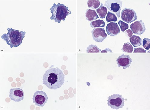 Leptomeningeal Myelomatosis: A Rare but Devastating Manifestation of ...
