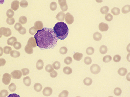 Morphological and Immunophenotypic Clues to the WHO Categories of Acute ...