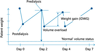 Significance of Interdialytic Weight Gain versus Chronic Volume ...