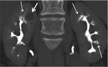 CT Urography for the Diagnosis of Medullary Sponge Kidney | American ...