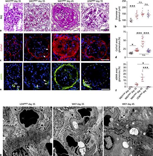 Differentiating Glomerular Inflammation from Fibrosis in a Bone Marrow ...