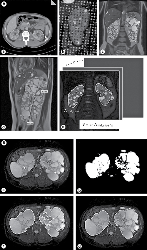 A Review of the Imaging Techniques for Measuring Kidney and Cyst Volume ...