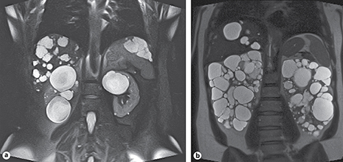 A Review of the Imaging Techniques for Measuring Kidney and Cyst Volume ...