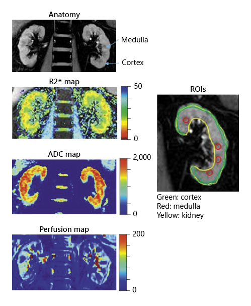 Medullary Blood Oxygen Level-Dependent MRI Index (R2*) is Associated ...