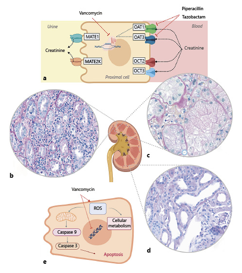 Nephrotoxicity from Vancomycin Combined with Piperacillin-Tazobactam: A ...