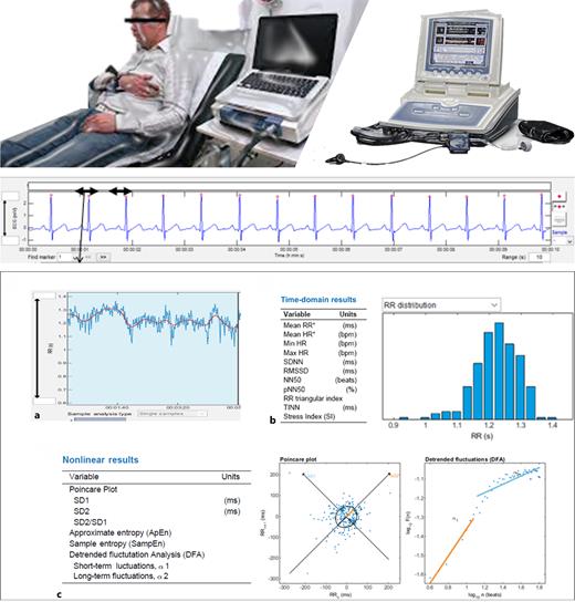 Autonomic Nervous System Dysfunction in Peritoneal Dialysis Patients ...