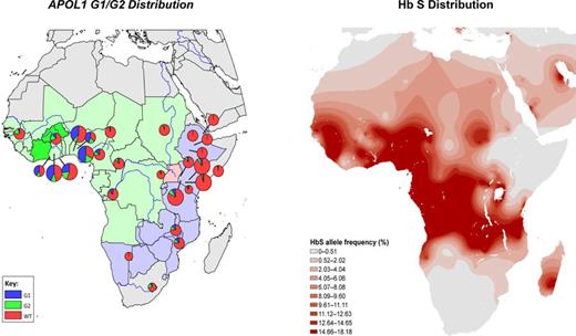 Sickle Cell Disease and CKD: An Update | American Journal of Nephrology ...