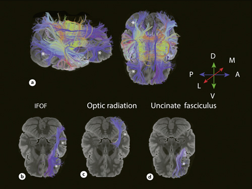 Mapping Human Brain Pathways: Challenges and Opportunities in the ...