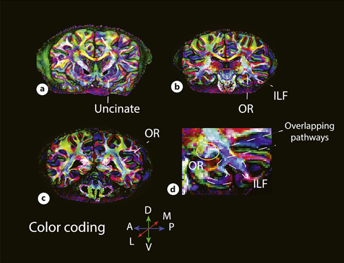 Mapping Human Brain Pathways: Challenges and Opportunities in the ...