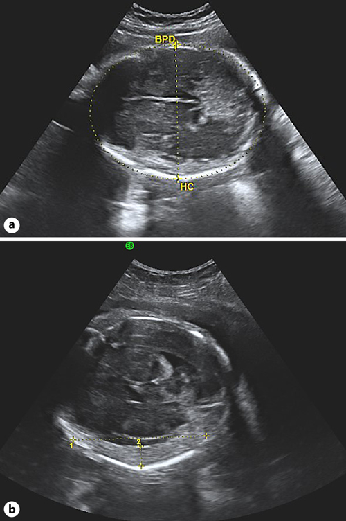 Warfarin-Associated Fetal Subdural Hematoma Causing Severe ...