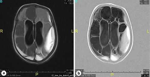 Warfarin-Associated Fetal Subdural Hematoma Causing Severe ...