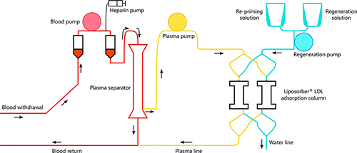 Extracorporeal Therapies in the Treatment of Focal Segmental ...