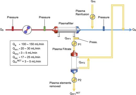 Extracorporeal Techniques in Kidney Failure | Blood Purification ...