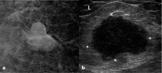 Differentiation between Phyllodes Tumors and Fibroadenomas Based on ...