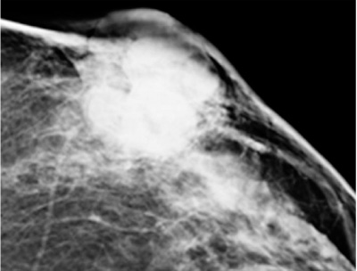 Differentiation between Phyllodes Tumors and Fibroadenomas Based on ...