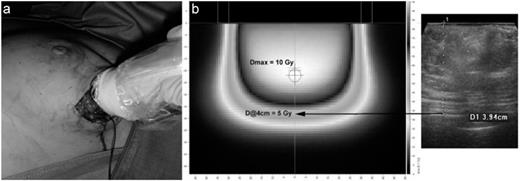 Intraoperative Electron Radiotherapy (IOERT) in the Treatment of ...