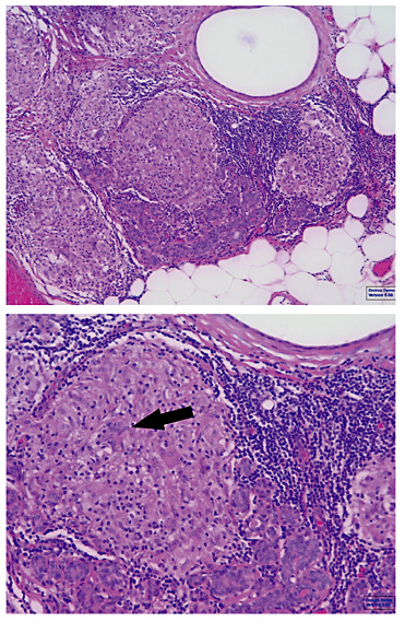 Granulomatous Mastitis: A Therapeutic and Diagnostic Challenge | Breast ...