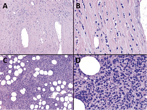 Histology of Luminal Breast Cancer | Breast Care | Karger Publishers