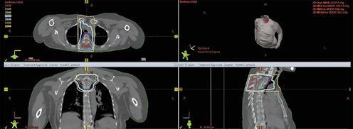 Ribociclib-Induced Pneumonitis: A Case Report | Breast Care | Karger ...