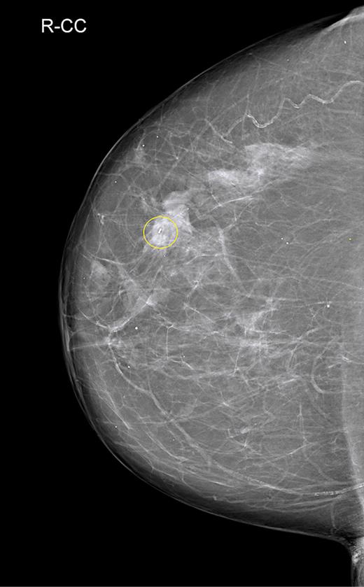 Magnetic Seed (Magseed) Localisation in Breast Cancer Surgery: A ...