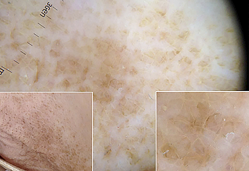 Terra Firme-Forme Dermatosis Diagnostic Sign and Treatment: A Case ...