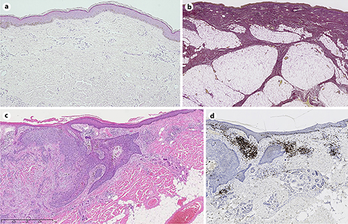 Spontaneous Regression of Annular Basal Cell Carcinoma: A Case Report ...
