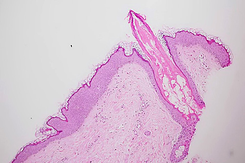 A Case Report of Idiopathic Follicular Hyperkeratotic Spicules and ...